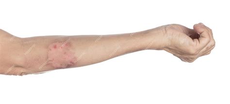 Premium Photo Scalded Skin From Hot Water Isolated On A White Background