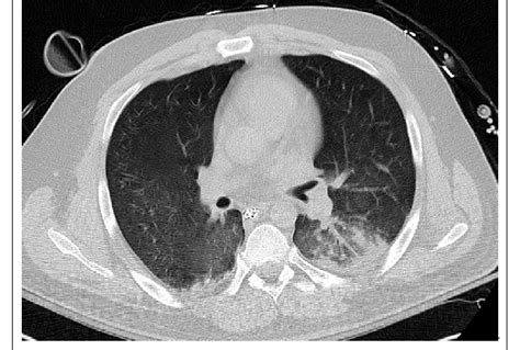 Computed Tomographic Imaging Of The Chest Hospital Day 6 Ecmo Day 6