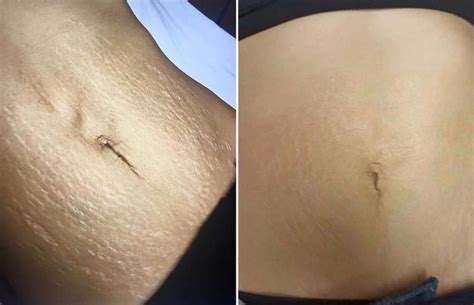 How To Get Rid Of Stretch Marks Before And After