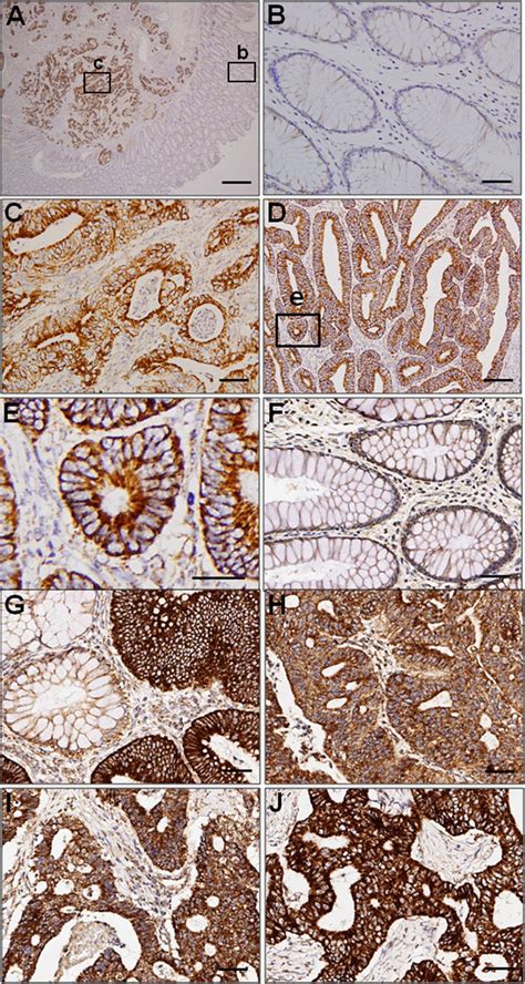 Ihc Analysis Of Stoml2 Expression In Crc Tissues Representative Ihc