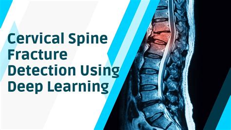Ae083 Cervical Spine Fracture Detection Using Deep Learning Youtube