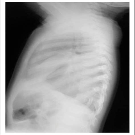 Anteroposterior Chest X Ray Revealing Homogenous Opacity In Right Lower Download Scientific