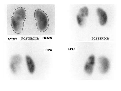 Acute Pyelonephritis