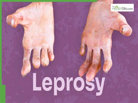 Understanding Leprosy Symptoms Transmission And Treatments Available