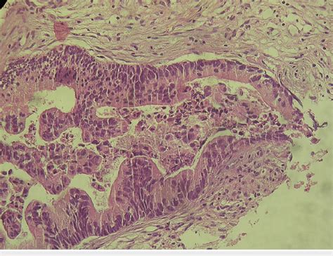 Malignant Epithelial Neoplastic Structures Of Adenocarcinoma Invading
