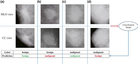 correct classification and misclassification of breast masses a and