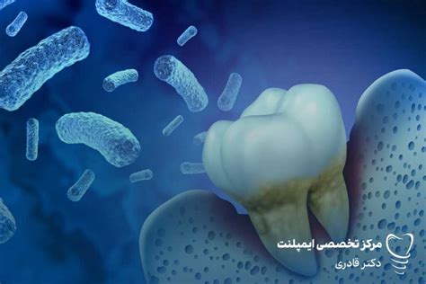 آبسه دندان وراه‌های درمان آن درمان فوری آبسه و ورم صورت