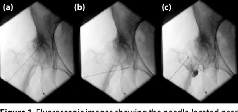 Figure 1 From Fluoroscopy Guided Triple Hip Block For Patients With Hip