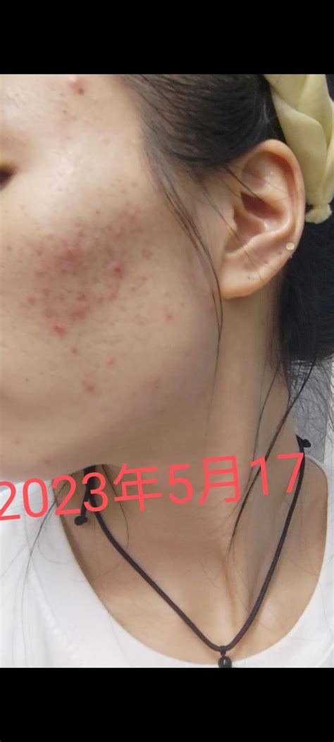 请问这种情况是否能服用泰尔丝异维a 知乎