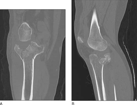 28 Proximal Tibia Fractures Musculoskeletal Key