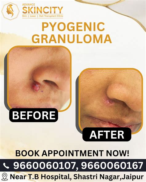 Advance 🌟 Pyogenic Granuloma Before And After Treatment 🌟 Pyogenic