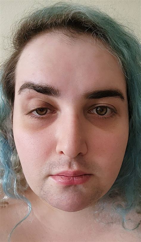 Two Months Post Op Ffs R Transgender Surgeries