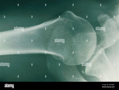 Tendon Calcification In The Shoulder Joint X Ray Of A Shoulder Joint Showing Acute