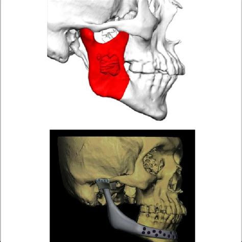 Digital Prediction Of Segmental Resection With Safety Margins Of 15 Cm