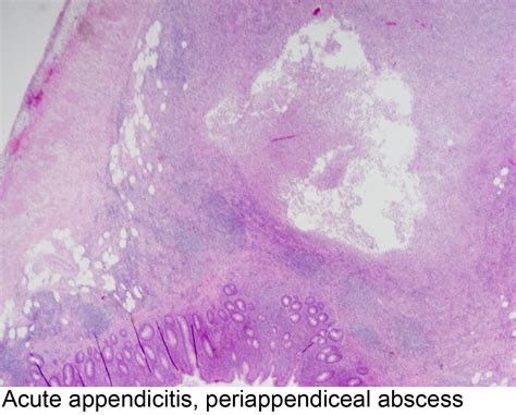 Pathology Outlines Acute Appendicitis