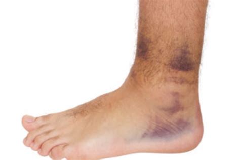 Verstuikte Enkel Thuisarts