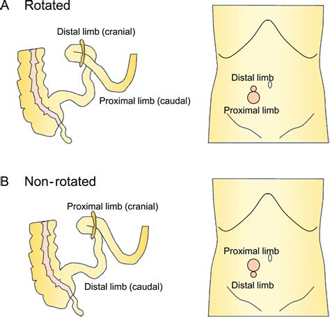 Influence Of The Rotation Of The Diverting Loop Ileostomy In Rectal Cancer Surgery On Small