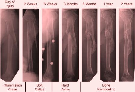 New Approach To Assess Fracture Healing Delhi Post