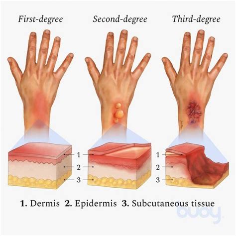 The 3 Types Of Burns First Degree Second Degree Third Degree