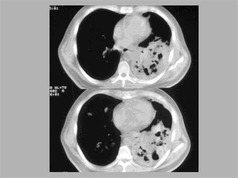 Pulmonary Vasculitis Jindal Chest Clinic Ppt