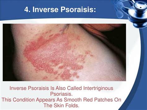 PPT The Five Main Types Of Psoriasis PowerPoint Presentation Free Download ID 6953239