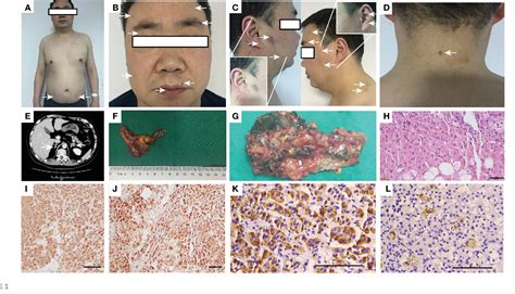 figure 1 from association between subclinical hyperthyroidism and a