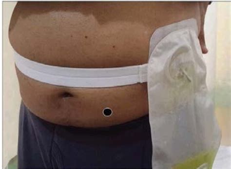 Cutaneous Ureterostomy Versus Ileal Conduit Outcomes And Cost