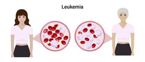 รูปภาพplasmocyte เลือกดูภาพถ่ายสต็อก เวกเตอร์ และวิดีโอ690 Adobe Stock