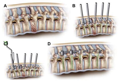 What Is Next In Computer Assisted Spine Surgery Advances In Image