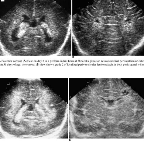 Relationship Between Sonographic Grades Of Periventricular Leukomalacia