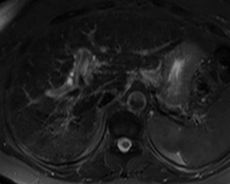 Liver Atlas Case 294 Yttrium 90 Radioembolization