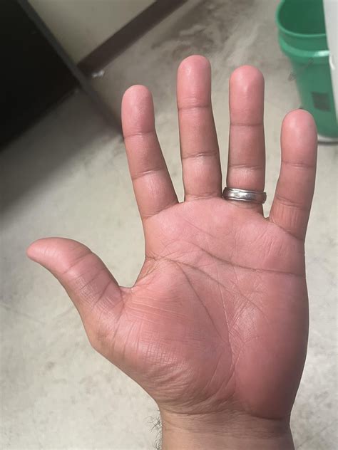 Dyshidrotic Eczema Red Palms R Dermatologyquestions