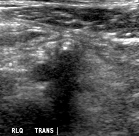 Acute Appendicitis Radiology Case Collection