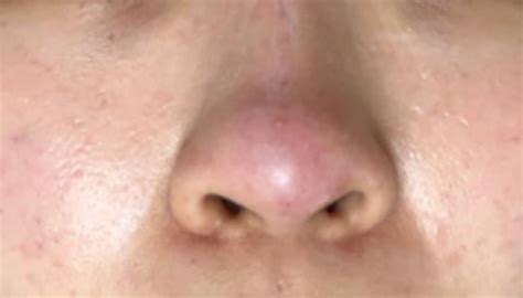 Normal Bruising Or Leading To Necrosis Rcosmeticsurgery