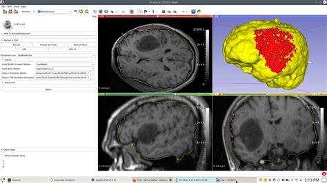 Craniotomy Induced Brain Shift — Slicercbm