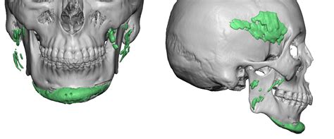 Plastic Surgery Case Study Female Jawline Reshaping With A Sliding