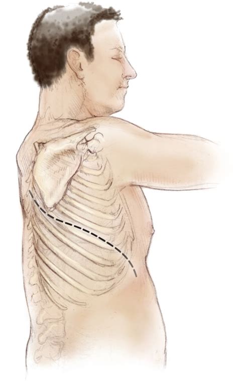 Extrapleural Pneumonectomy And Extended Pleurectomydecortication For