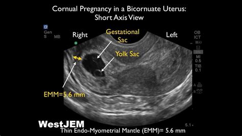 Bicornuate Uterus Causes Symptoms Ultrasound