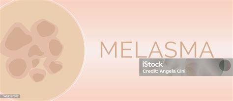 Melasma Skin Condition Illustration Design Stock Illustration