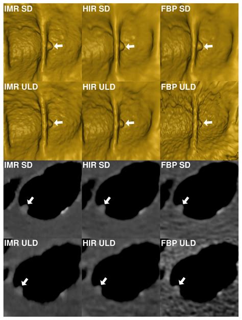 Sub Millisievert Ultralow Dose Ct Colonography With Iterative Model Reconstruction Technique [peerj]