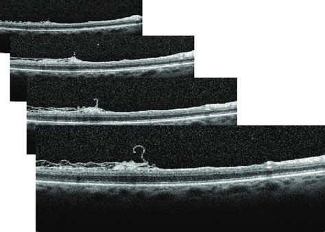 A Quizzical OCT Macular OCT Demonstrating Visually Significant Download Scientific Diagram