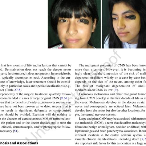 Pdf Congenital Melanocytic Nevi