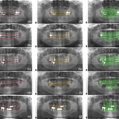 Pdf Deep Learning Hybrid Method To Automatically Diagnose Periodontal
