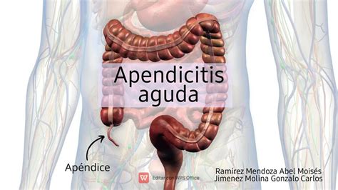 Apendicitis Aguda Andrés Vázquez Udocz