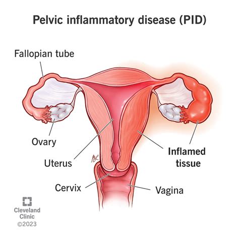 Pelvic Inflammatory Disease Pid Punarva