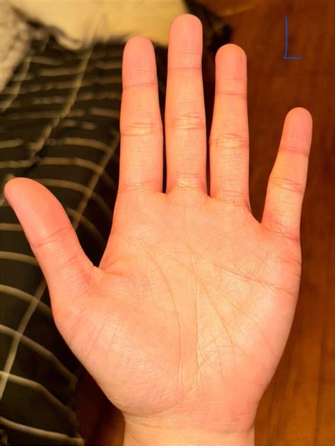 Hi Im F21 And Im Really Scared About Maybe Having Scleroderma R Scleroderma