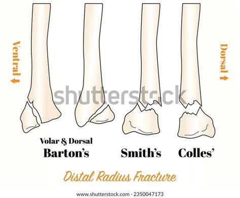 Different Types Distal Radius Fracture Vetor Stock Livre De Direitos 2350047173 Shutterstock