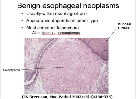 Upper Gi Malignancy Flashcards Quizlet