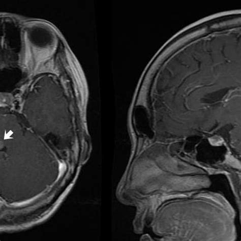 Contrast Enhanced Transverse Left And Sagittal Right T1 Weighted