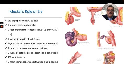 Meckels Diverticulum When The Rule Of Twos Meets Real World Endoscopy